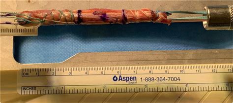 Intraoperative Photo Of The Final 5 Strand Hamstring Graft Download Scientific Diagram