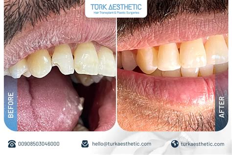 Broken Tooth Treatment In Turkey 2025 Turk Aesthetic