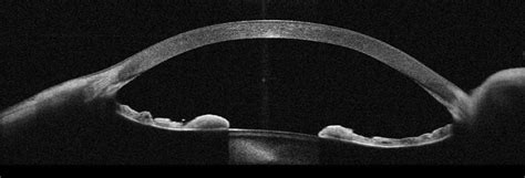 Oct Observations Utilizing Full Range Anterior Chamber Scans In The Management Of Glaucoma