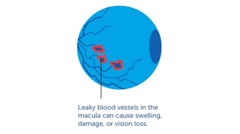 Geographic Atrophy Fact Sheet