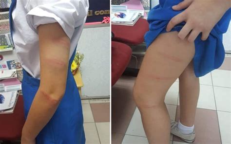 Investigation Launched After Teachers Caning Leaves Red Marks On Girl