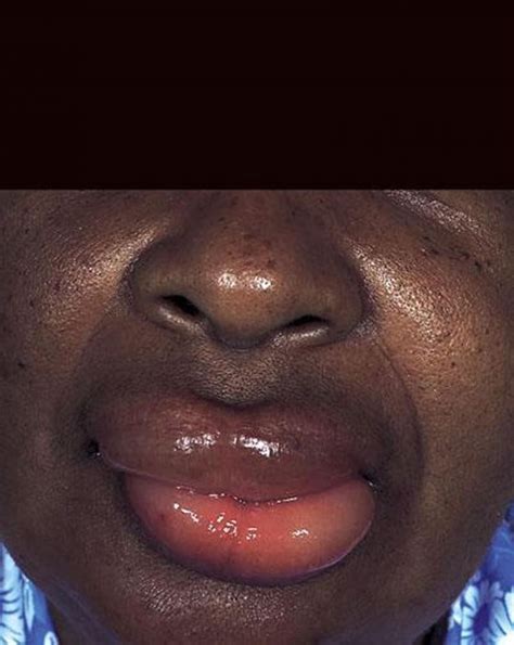 Angioedema Hereditario Y Adquirido Angioedema Hereditario Y Adquirido