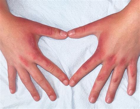 Doxycycline Induced Phototoxicity New England Journal Of Medicine