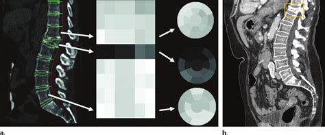 Automated Detection Of A Vertebral Fracture With Two Different Download Scientific Diagram