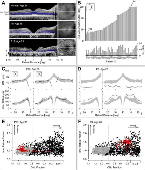 Outer And Inner Retinal Abnormalities In Abca4 Rd A Cross Sectional Download Scientific