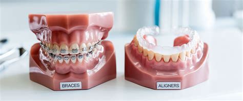 Clear Aligners Vs Metal Braces A Detailed Comparison 2025