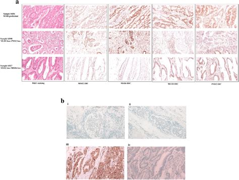 Mmr And Braf Ihc Hande And Ihc Profiles Of A Proficient Mmr Dmmr Download Scientific Diagram