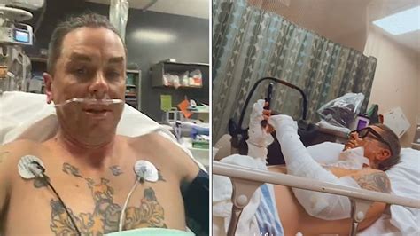 Slipknots Sid Wilson Suffers Serious Burns In Accident
