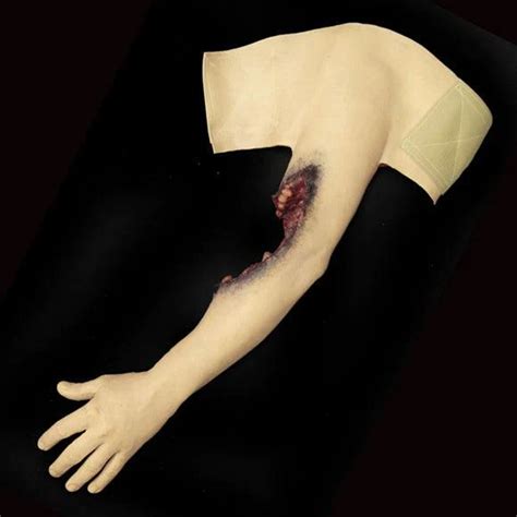 Partial Arm Amputation Left Skedcoeu