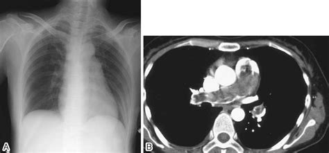 Figure 1 From A Case Of Intimal Sarcoma Of The Pulmonary Artery Treated With Chemoradiotherapy