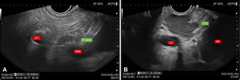 Impact Of Eus In Liver Transplantation Workup For Patients With