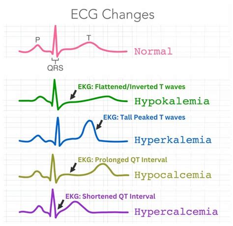 Hypocalcemia Ecg