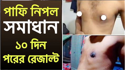 Grade 1 Puffy Nipple Gynecomastia Surgery Result Male Breast Reduction Surgery Bangladesh