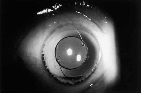 Expulsive Choroidal Hemorrhage Semantic Scholar