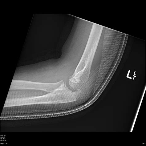 Olecranon Fractures Don T Forget The Bubbles