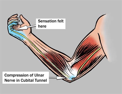 Ulnar Nerve Entrapment Test