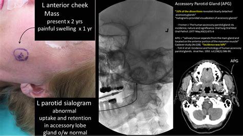 Parotid Gland Accessory Lobe And Facial Process Management Considerations Iowa Head And Neck