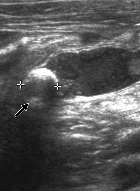Journal Club Ultrasound For Differentiation Between Perforated And Nonperforated Appendicitis