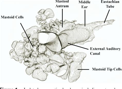 Figure 1 From Temporal Bone Pneumatization In Otosclerosis Semantic Scholar