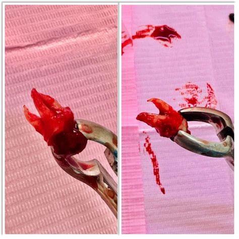 Grossly Decayed Upper Third Molar Dr Fathima Yasmine