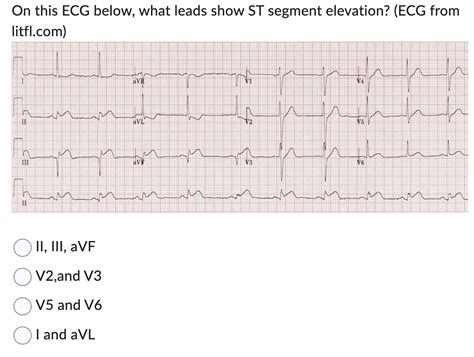 Solved On This Ecg Below What Leads Show St Segment