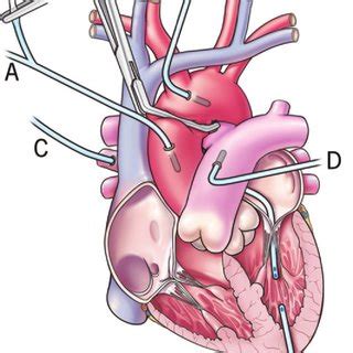 Drawing Shows Various Left Ventricular Venting Routes With Cannulation