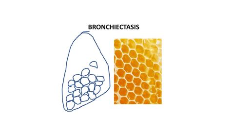 Pathology Of Bronchiectasis Pathology Made Simple