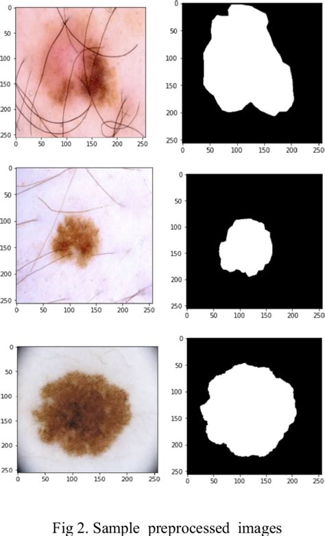 Figure 4 From Skin Lesion Segmentation Using Residual U Net Semantic