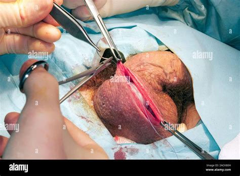 Epididymal Zyste Entfernung Chirurgie Chirurg Naht Geschlossen Eines