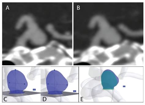 Implications Of An Ai Enabled Volumetric Aneurysm Measurement Tool