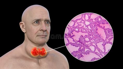 A Man With Enlarged Thyroid Gland 3d Illustration And Micrograph Toxic Goiter Stock
