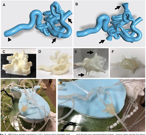 Figure 1 From Simulation Model Of Arteriovenous Malformation Embolization Using Onyx Semantic