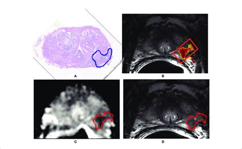 A 71 Year Old Man With Gleason Score 3 4 Gg 2 Prostate Cancer