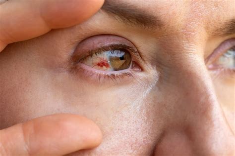 Subconjunctival Hemorrhage Why Your Eye Turns Red