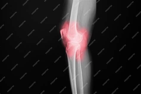 Film Xray Knee Of Osteoarthritis Knee Patient And Artificial Joint Premium Ai Generated Image