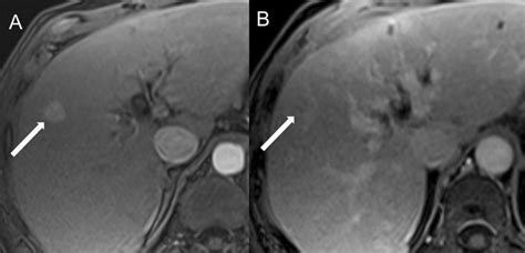 Example Of An Intrahepatic Cholangiocarcinoma Icca With A Download Scientific Diagram