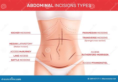 Abdominal Incision Types Infographics Stock Vector Illustration Of Female Charts 289147171