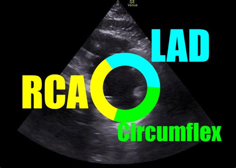 Regional Wall Motion Abnormality Searcy Em