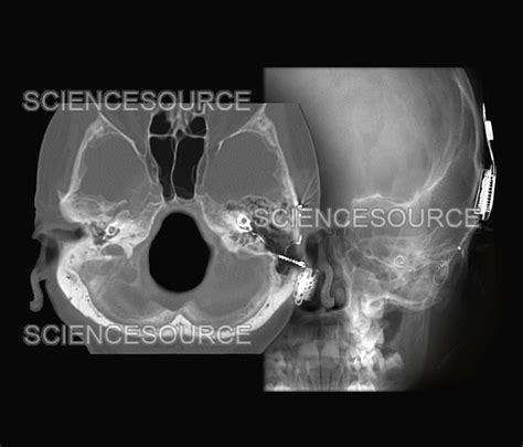 Cochlear Implant Ct Scan And X Ray Stock Image Science Source Images