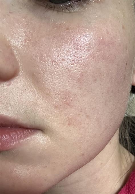 Newly Diagnosed Type 2 R Rosacea