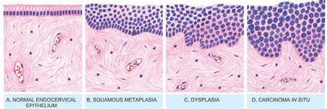 Epithelial Changes MEDizzy