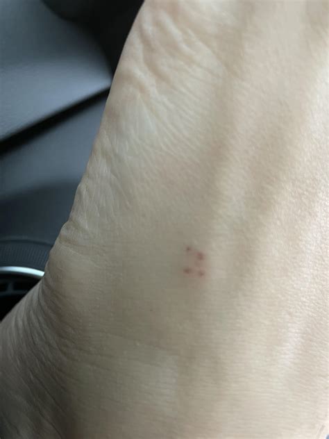 What Bite Is This R Bugbites