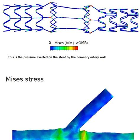 Stage 1 Result Of The Finite Element Simulations—stresses On The Stent