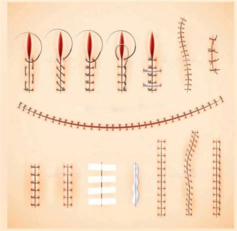 Surgical Sutures And Their Types