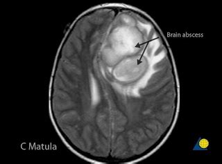 Brain Abscess Rnpedia
