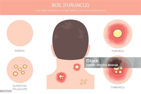 Boil Furuncle Carbuncle Skin Diseases Medical Infographic Design Stock
