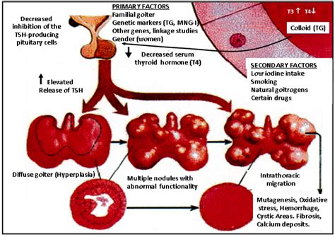 Multinodular Goiter Endotext Ncbi Bookshelf