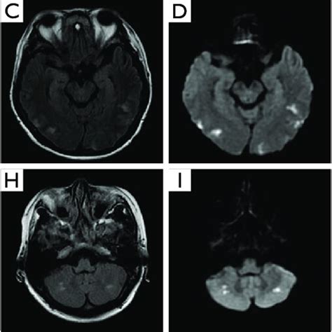Cranial Imaging Of The Patients Cerebral Infarction A J Mri Shows Download Scientific