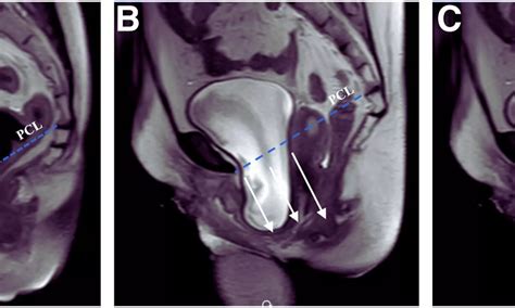 Study Finds New Mri Technique For Pelvic Organ Prolapse Assessment
