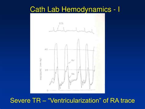 Ppt Cath Lab Hemodynamics I Pressure Tracings In The Diseased